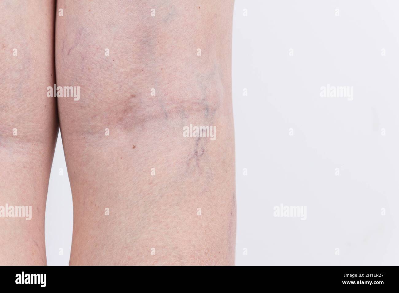 The old age and sick of a woman. Varicose veins on a legs of woman. The ...