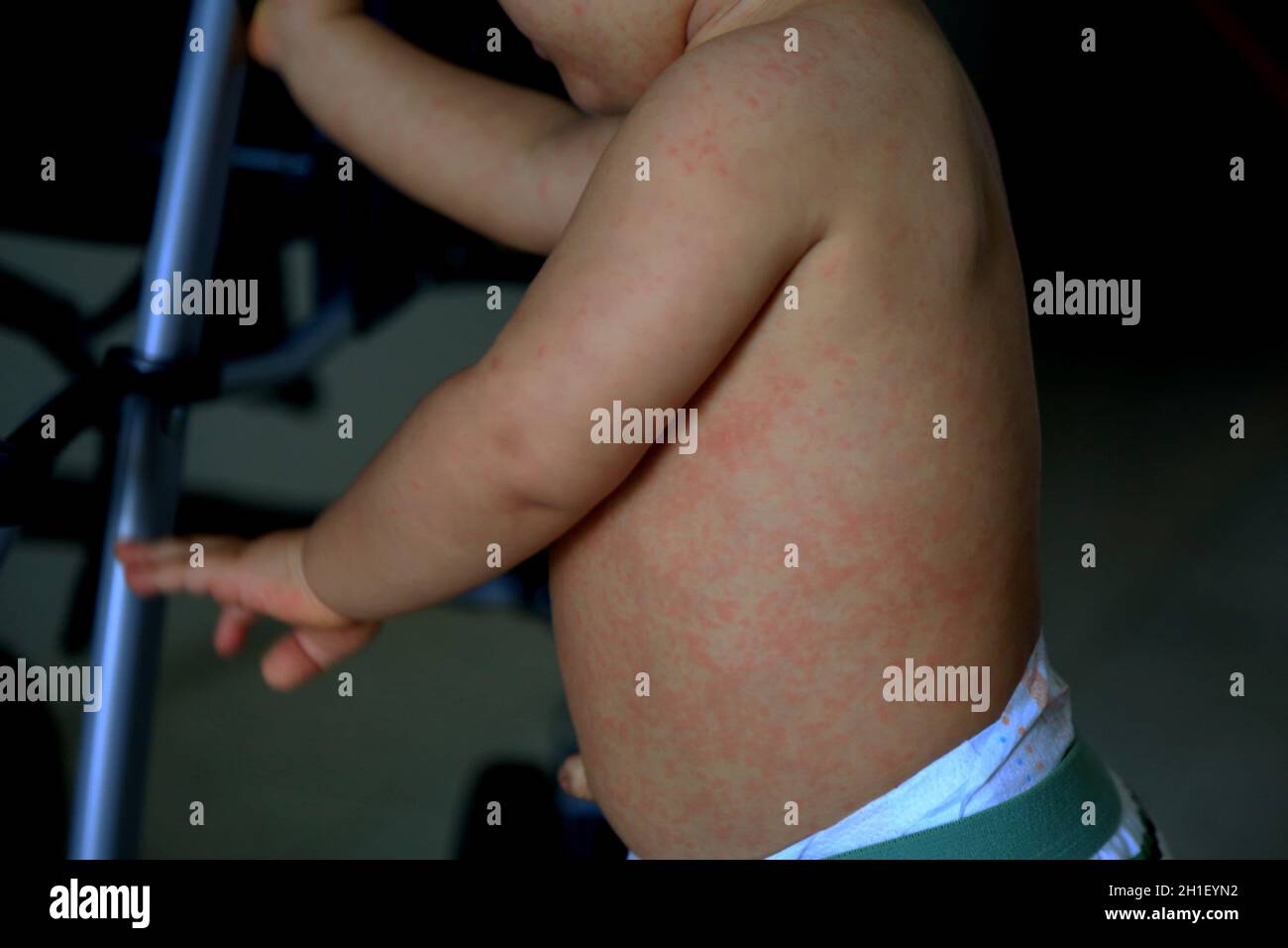 salvador, bahia / brazil - february 14, 2017: Child with measles ...