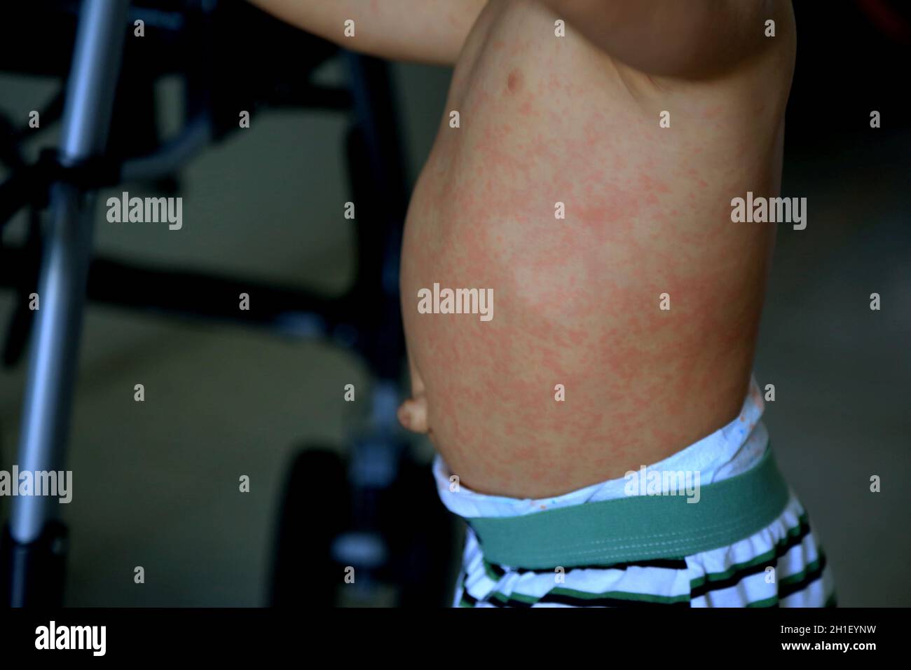 salvador, bahia / brazil - february 14, 2017: Child with measles ...