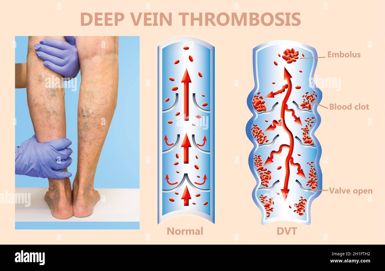 Female vein anatomy hi-res stock photography and images - Alamy