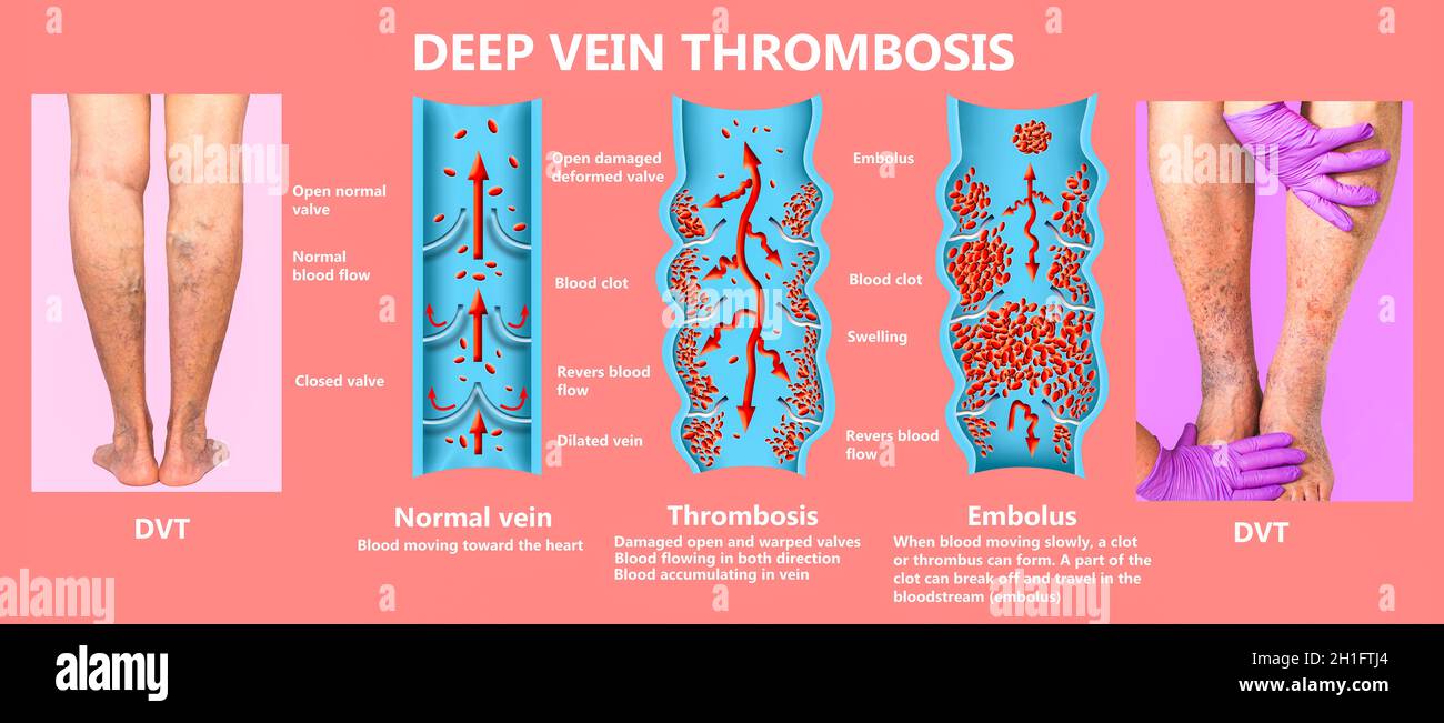 Deep Vein Thrombosis or Blood Clots. Embolus. Structure of normal and ...