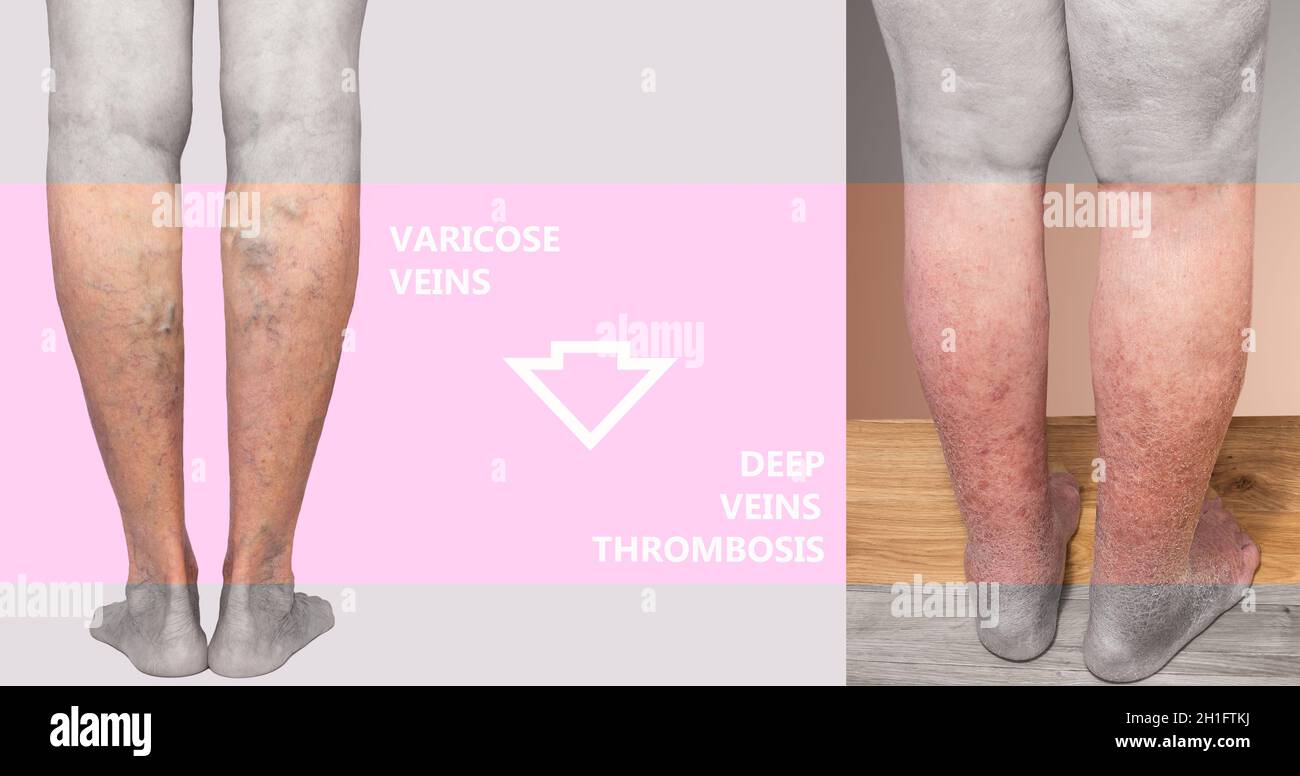 Collage about varicose veins and hyperpigmented lower limb secondary to ...