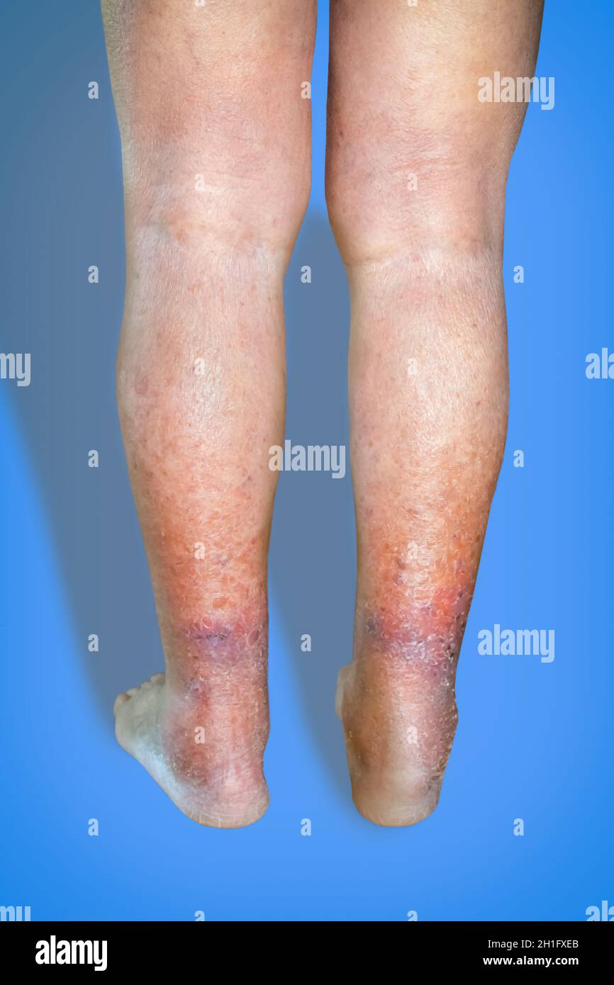 Close-up of skin with varicose veins on senior male leg. Concept of dry ...
