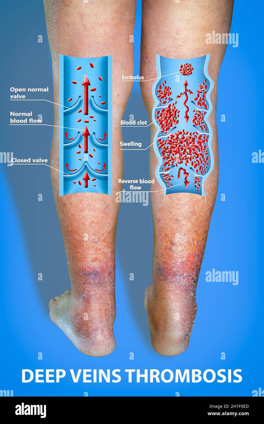 Dvt on skin hi-res stock photography and images - Alamy