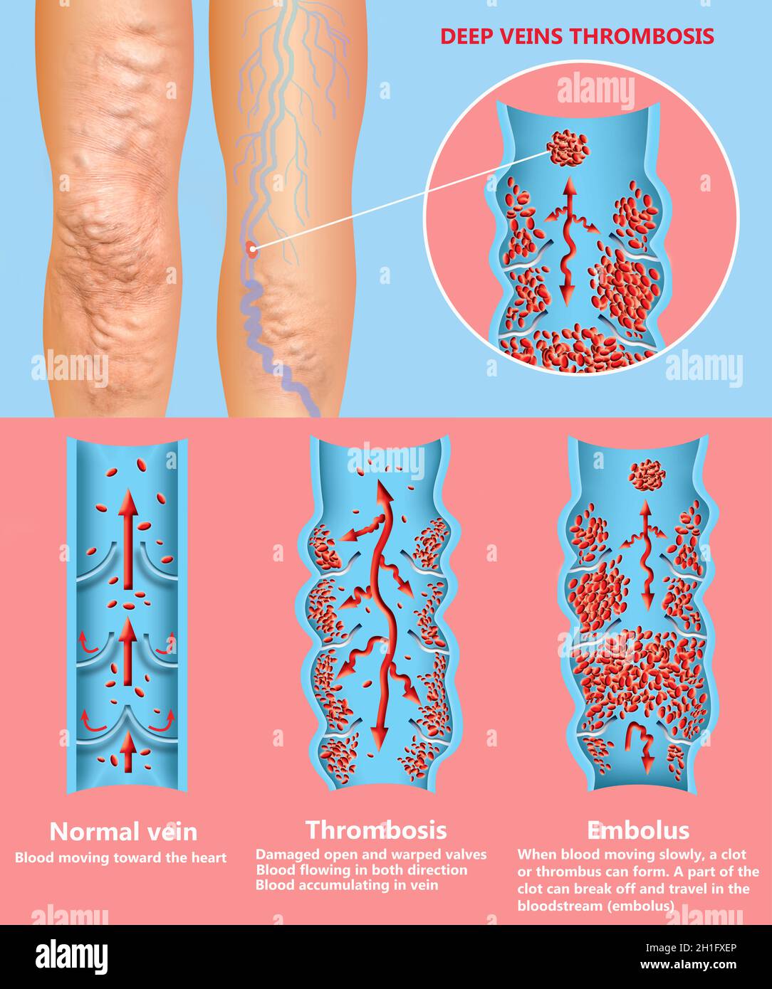 Deep Vein Thrombosis or Blood Clots. Embolus. Structure of normal and ...