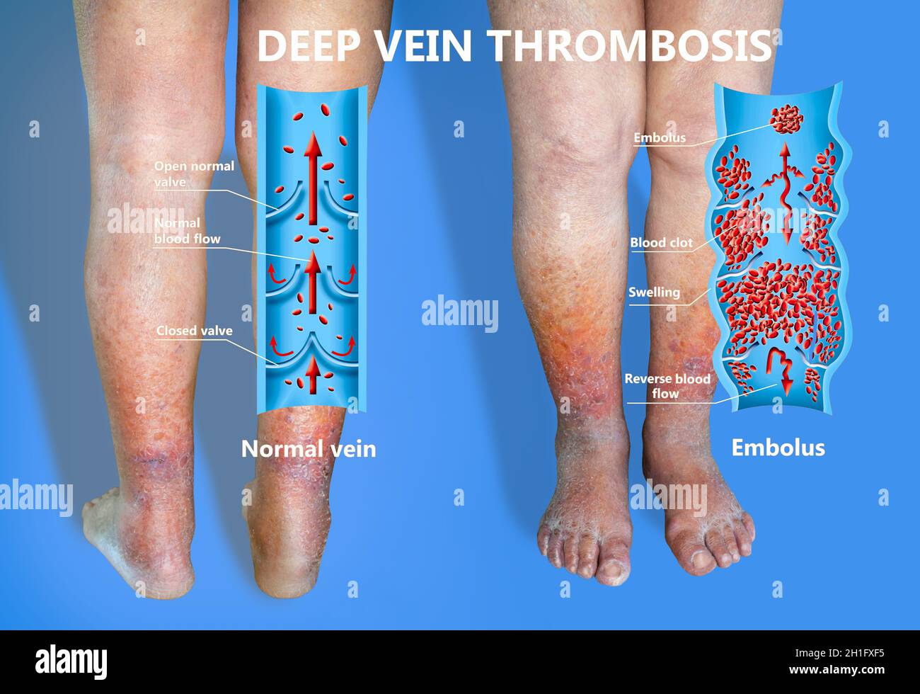 Close-up of skin with varicose veins on senior male leg. Concept of dry ...