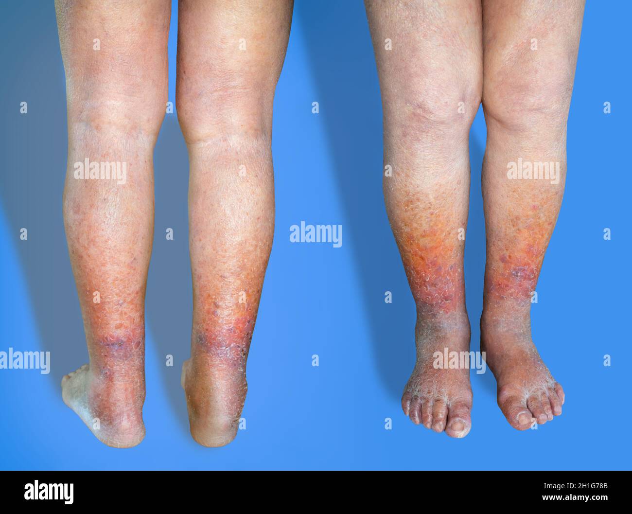 Deep vein thrombosis risk hi-res stock photography and images - Alamy