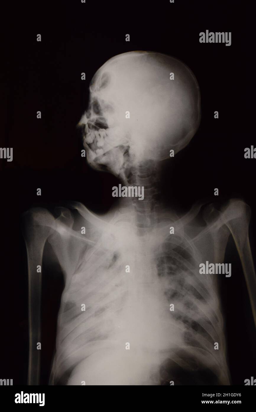 Chest radiograph hi-res stock photography and images - Alamy