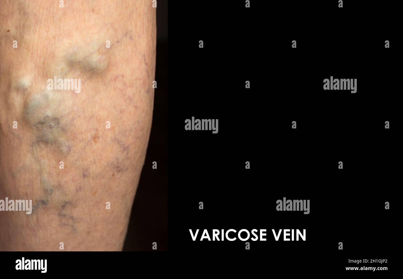 The old age and sick of a woman. Varicose veins on a legs of old woman ...