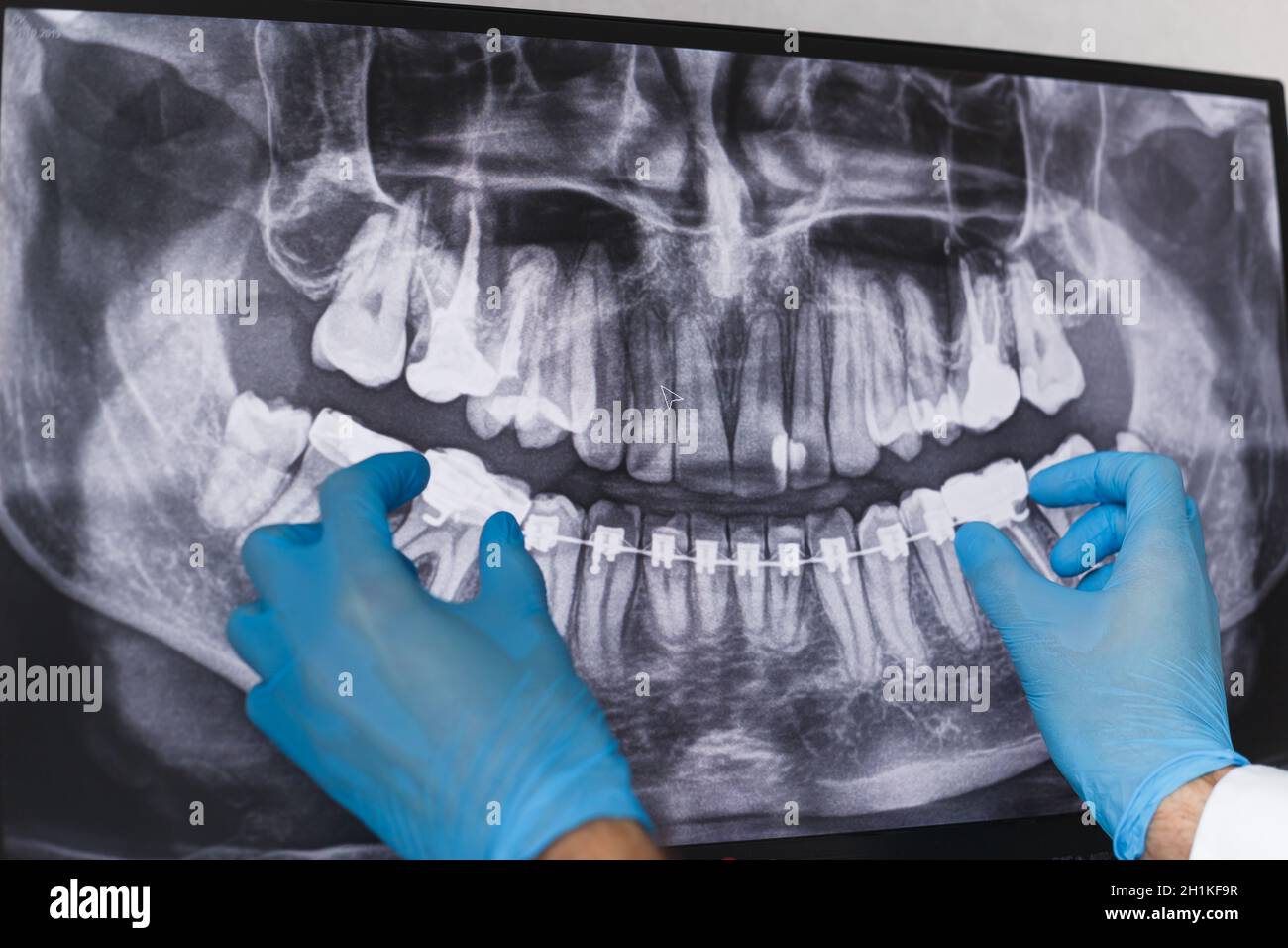 Doctor points to braces in dental x-ray Stock Photo - Alamy
