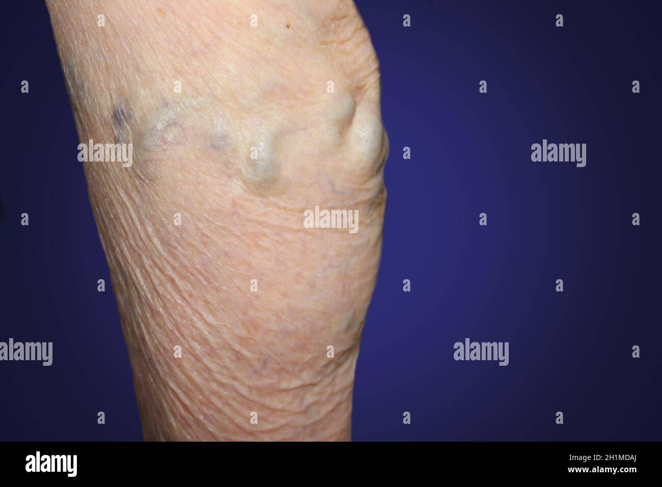 The old age and sick of a woman. Varicose veins on a legs of old woman ...