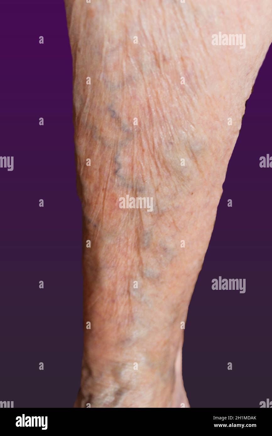 The old age and sick of a woman. Varicose veins on a legs of old woman ...