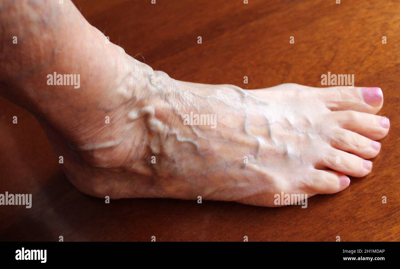 The old age and sick of a woman. Varicose veins on a legs of old woman ...