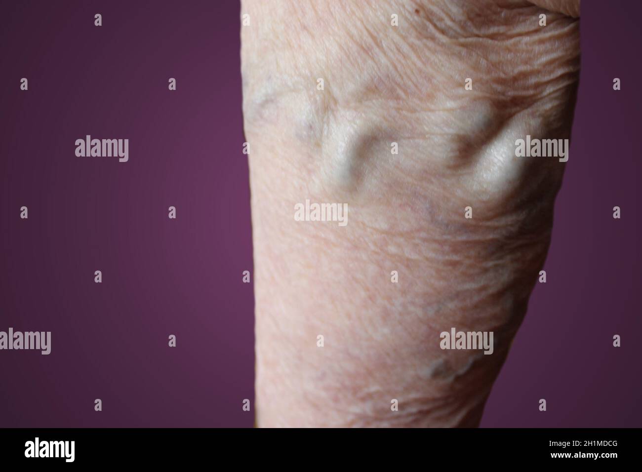 Old woman with varicose veins hi-res stock photography and images - Alamy