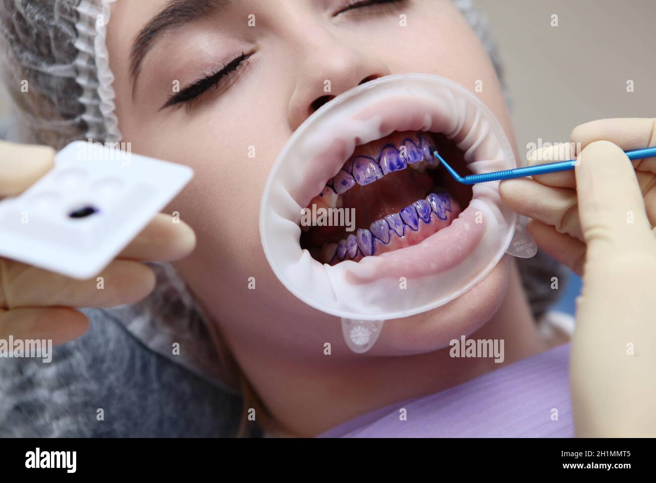 The dentist applies the tooth of a purple gel on the patient's teeth ...