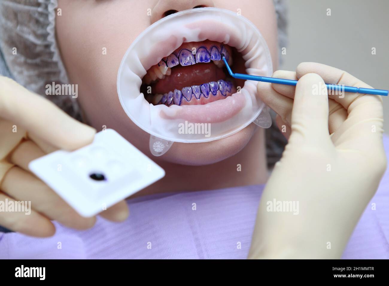 The dentist applies the tooth of a purple gel on the patient's teeth ...