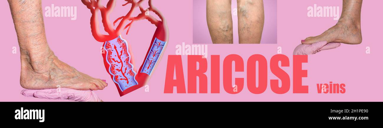 Varicose veins on a female senior legs. Concept of dry skin, old senior ...