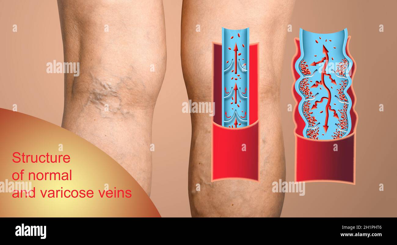 The old age and sick of a woman. Varicose veins on a legs of woman. The ...