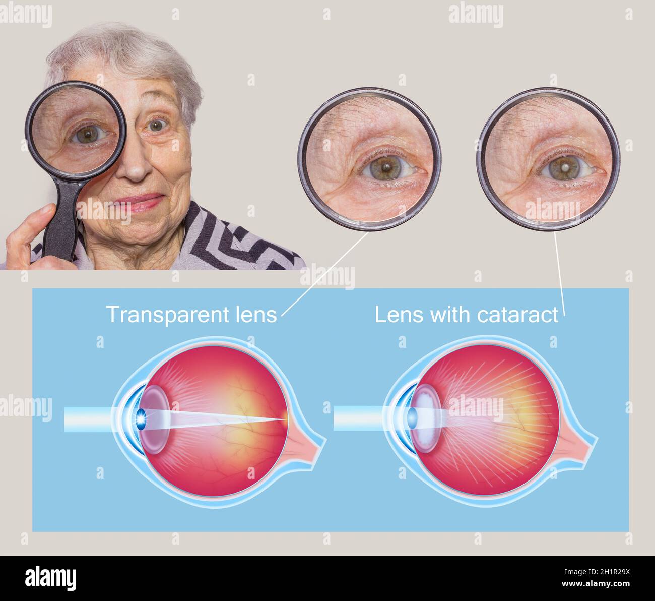Cataract concept. Senior woman's eye, closeup and cataracts and healthy ...
