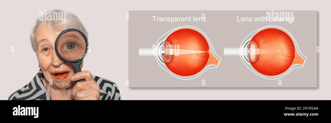 Cataract concept. Senior woman's eye, closeup and cataracts and healthy ...