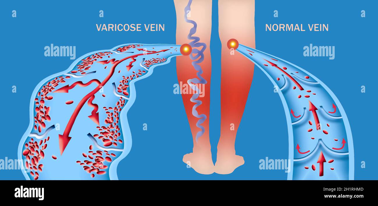 Varicose veins on a female senior legs. The structure of normal and ...