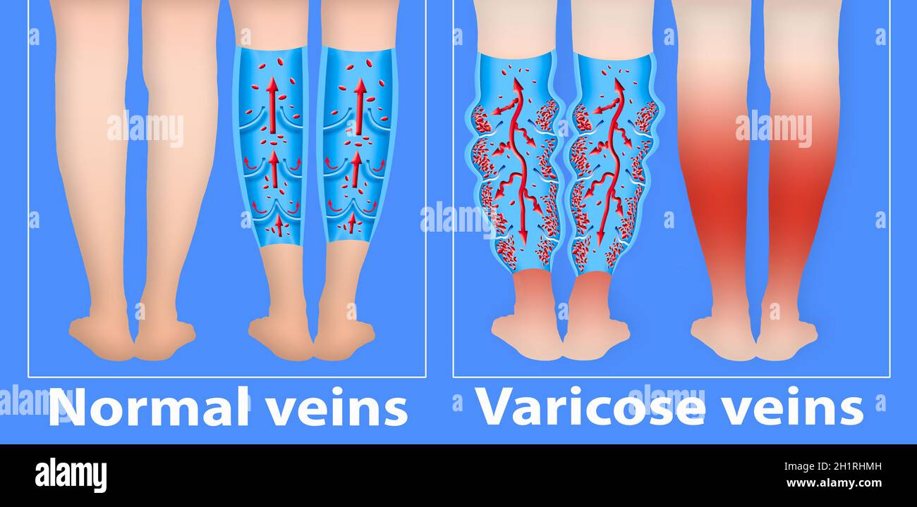 Varicose veins on a female senior legs. The structure of normal and ...