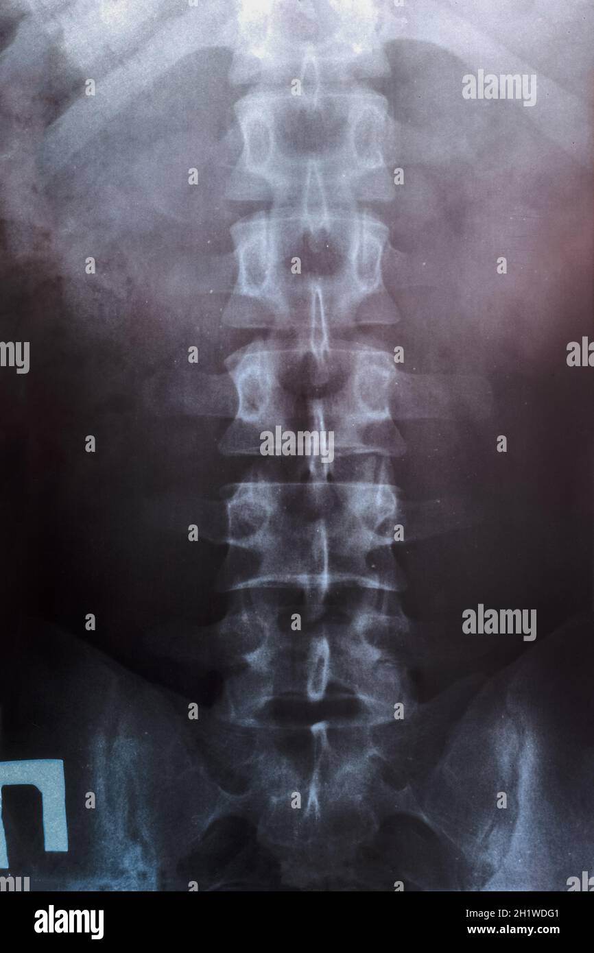 X-ray of the lumbar spine, spine on x-ray Stock Photo - Alamy