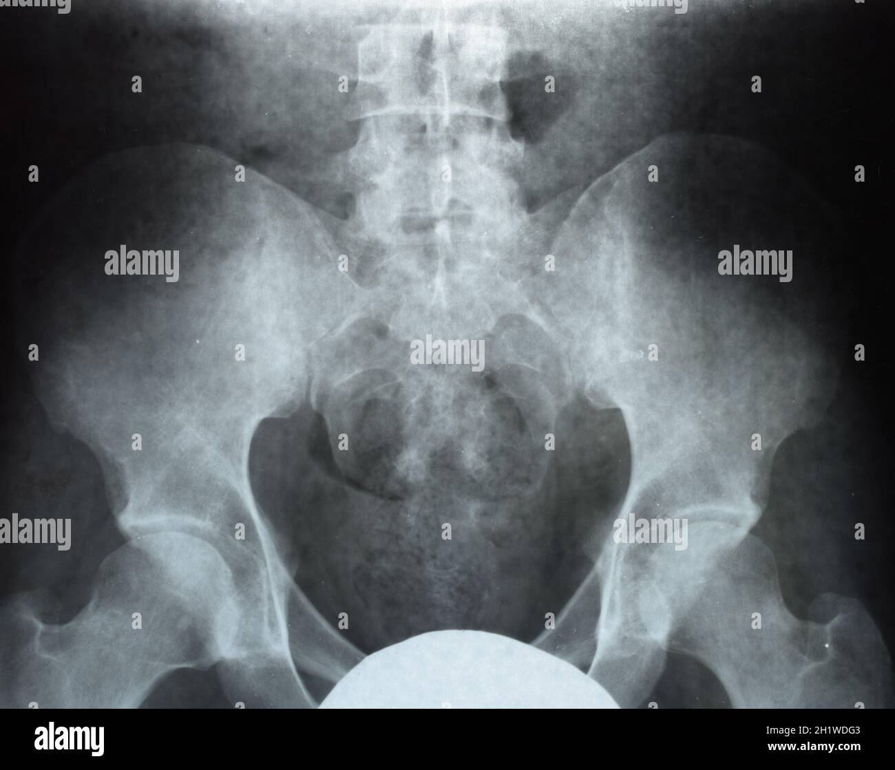 Broken pelvis hi-res stock photography and images - Alamy