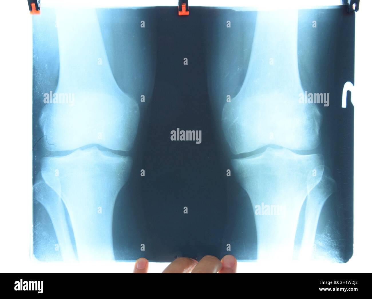 Bones of the knee hi-res stock photography and images - Alamy