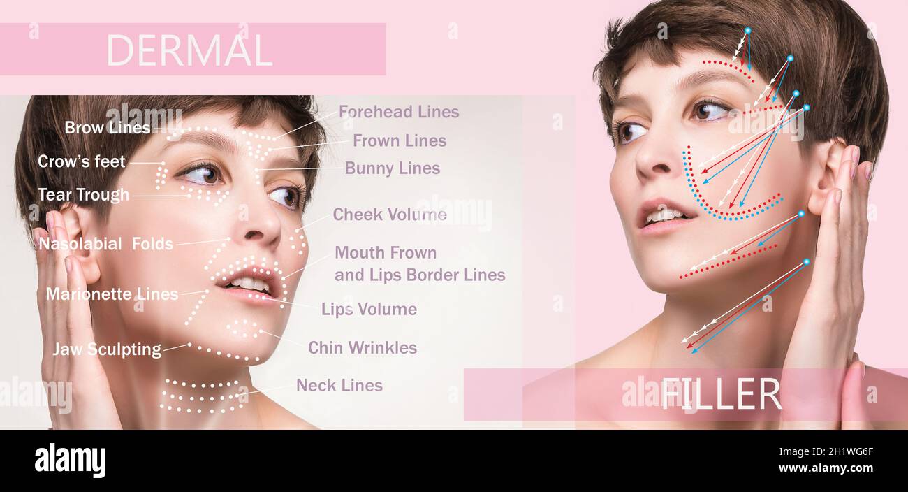 Dermal filler treatments areas .Hyaluronic acid anr thread lifting for ...