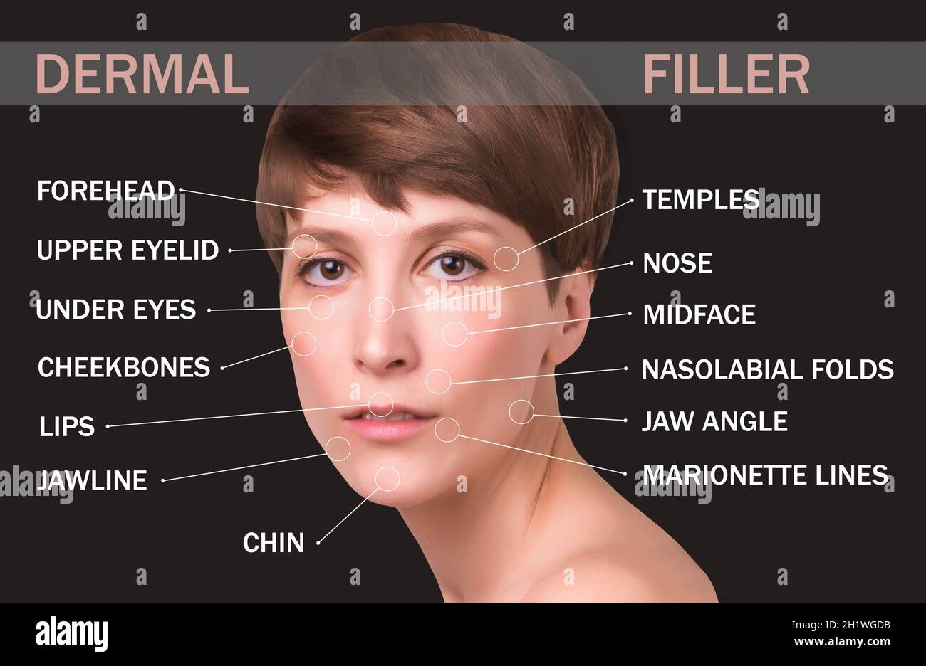 Dermal filler treatments areas .Hyaluronic acid anr thread lifting for ...
