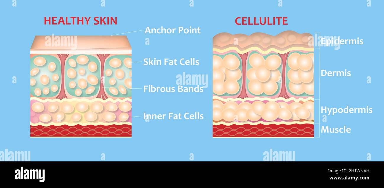 Forming of underskin cellulite illustration. Structure of normal ...