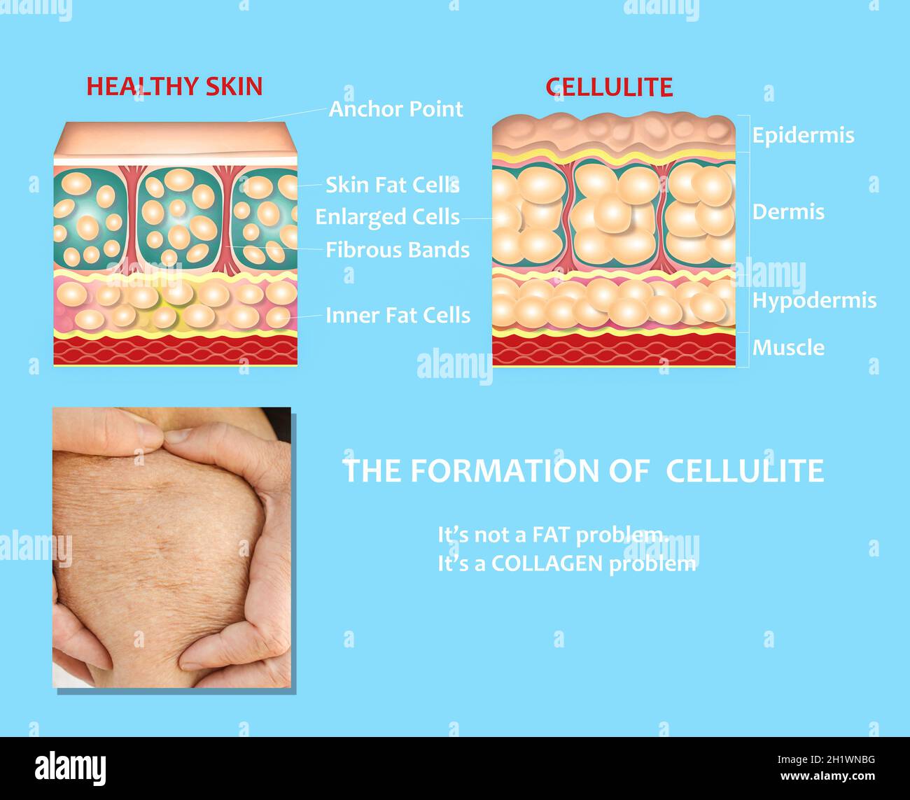 Forming of underskin cellulite illustration. Structure of normal ...