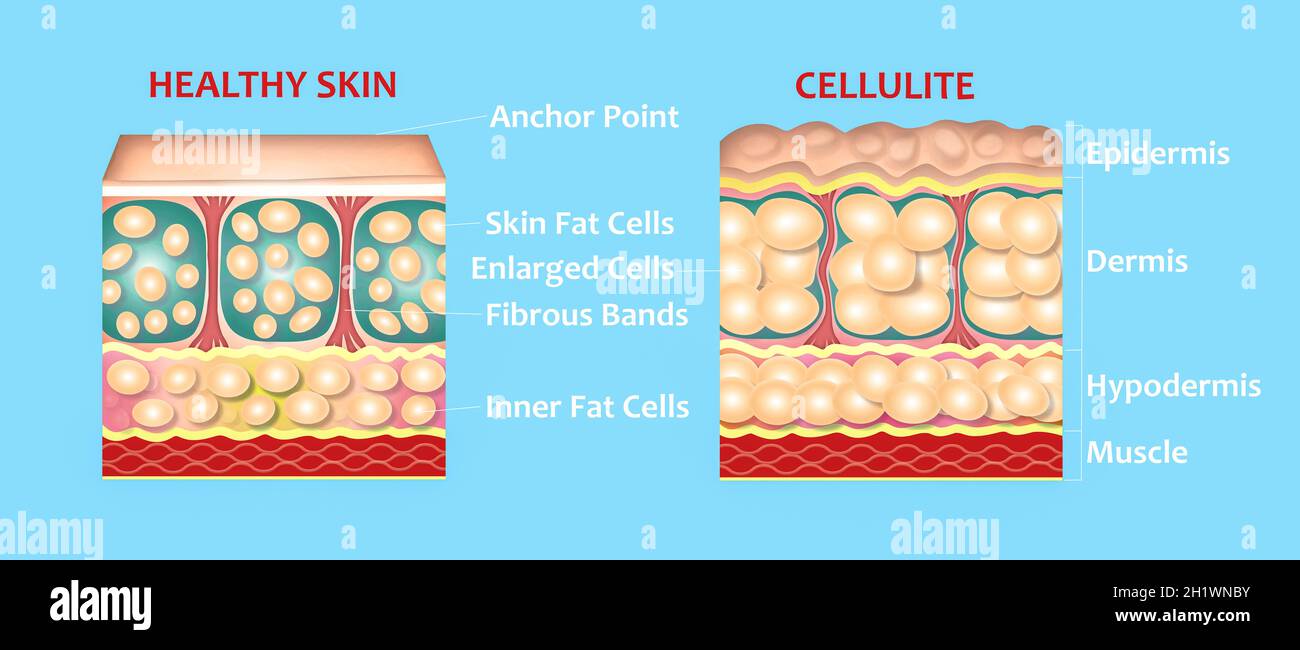 Forming of underskin cellulite illustration. Structure of normal ...