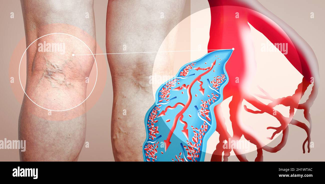 Varicose veins on a female senior legs. The structure of normal and ...