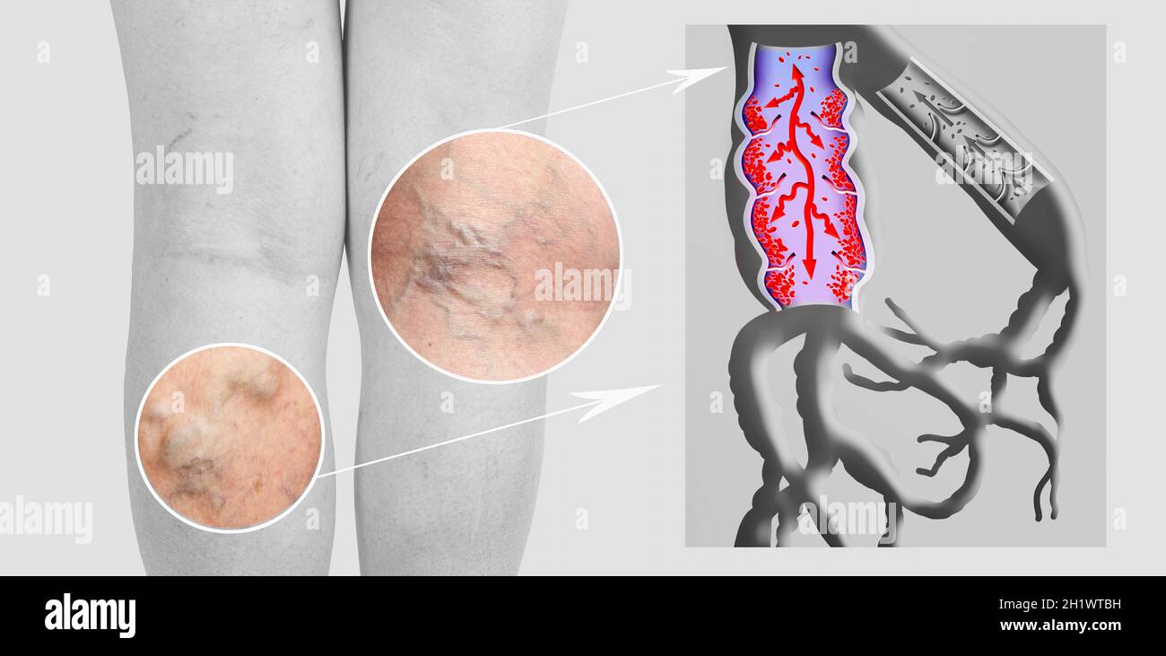 Varicose veins on a female senior legs. The structure of normal and ...