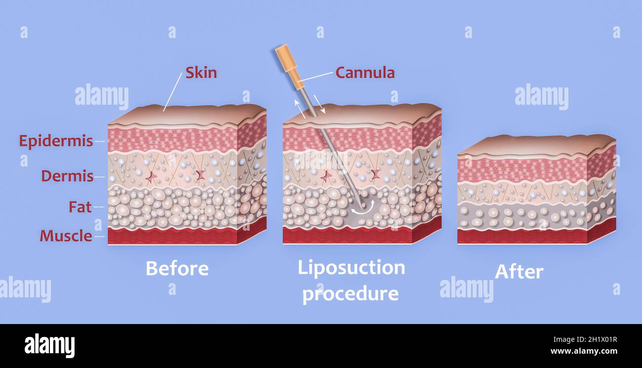 Mechanism of liposuction. Suction-assisted liposuction. Hollow tube or ...