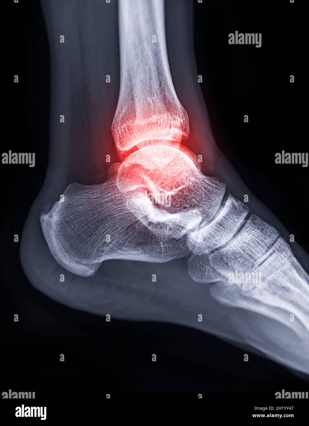 X-ray image of ankle joint showing fracture of ankle joint Stock Photo ...