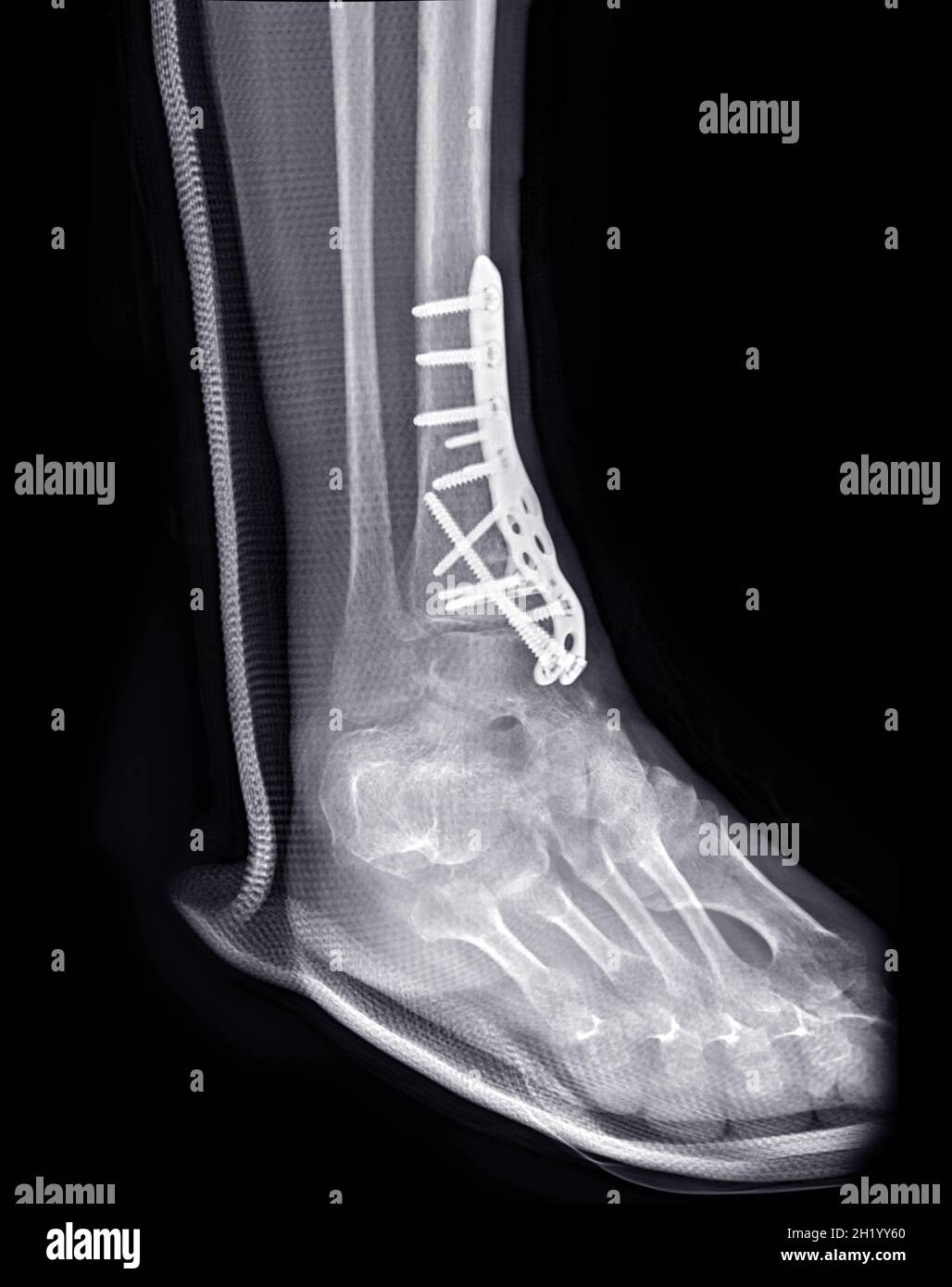 X-ray image of ankle joint showing surgical treatment by internal ...