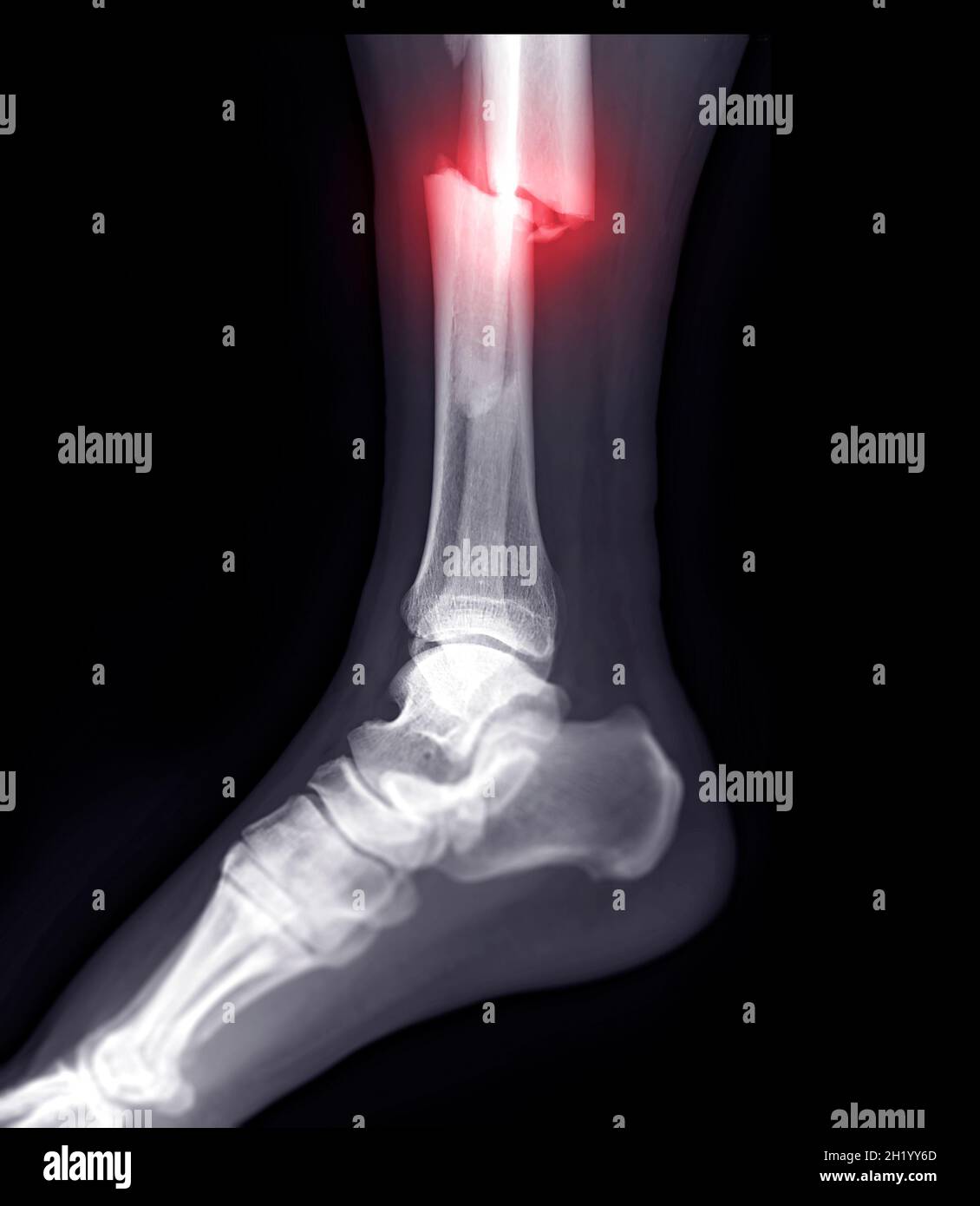 X-ray image of ankle joint showing fracture tibia and fibula bone ...