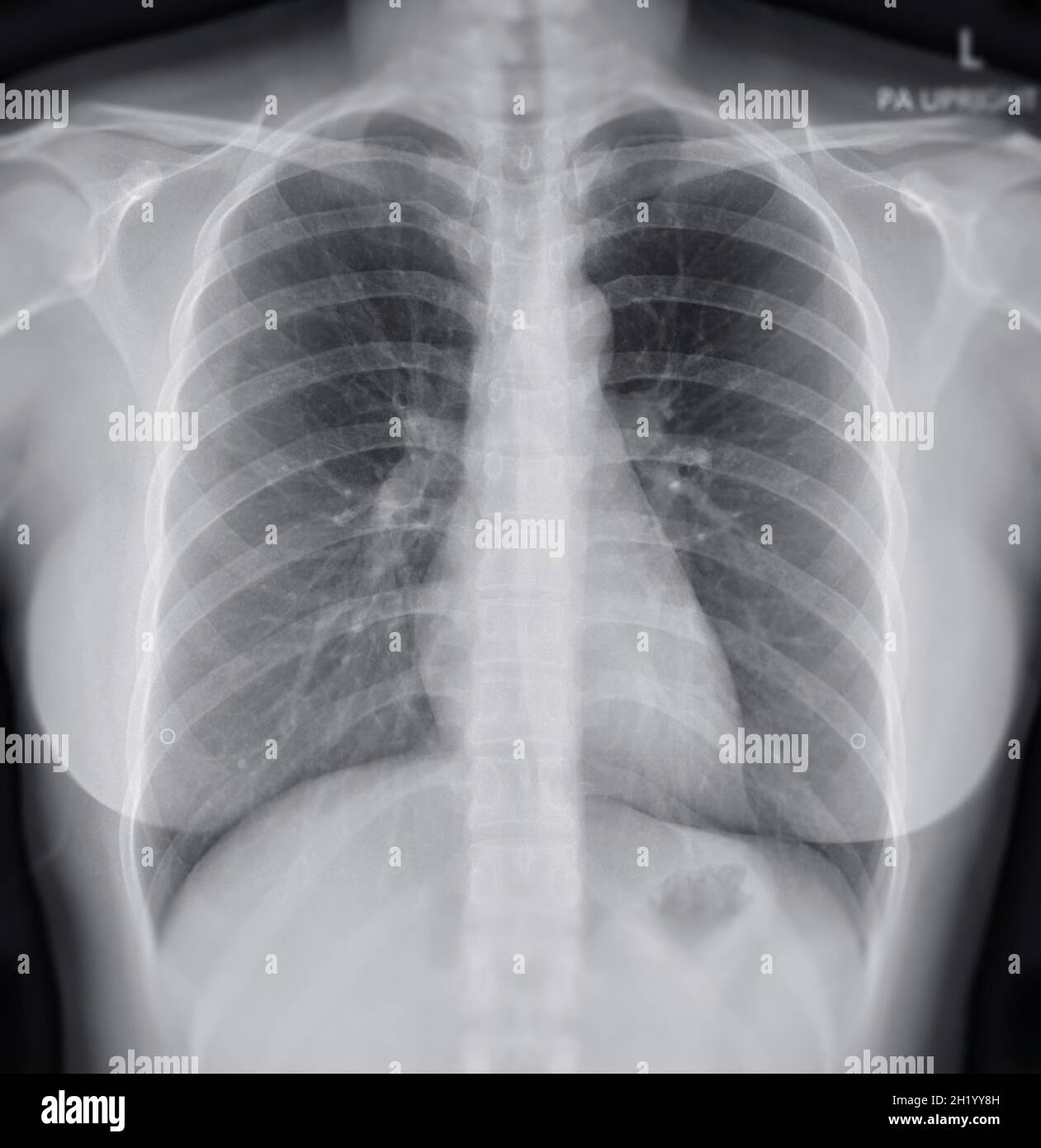Chest X-ray Of Human Chest or Lung showing normal lung Stock Photo - Alamy