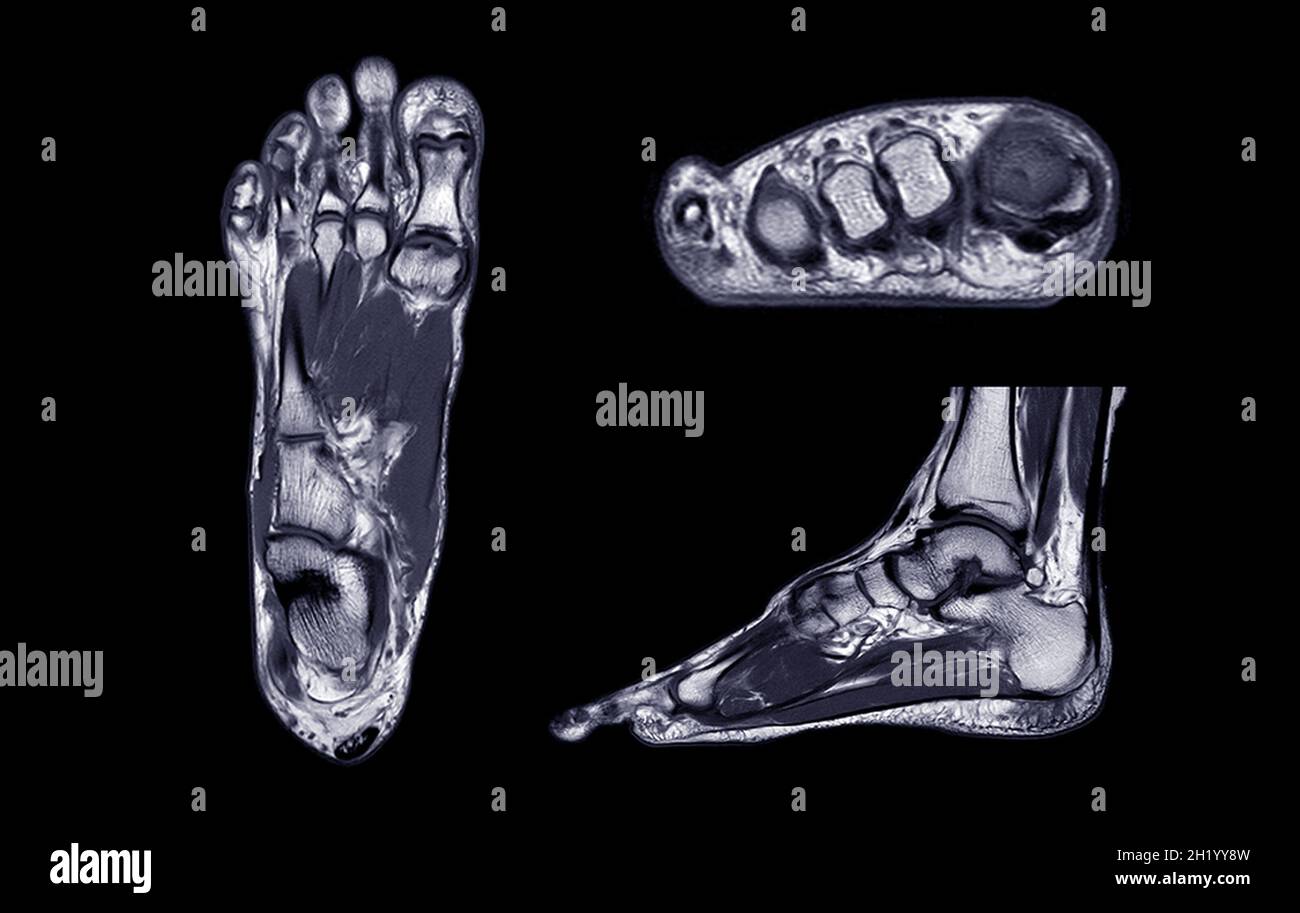 Manetic resonance imaging of foot or MRI FOOT PDW axial, Coronal and ...
