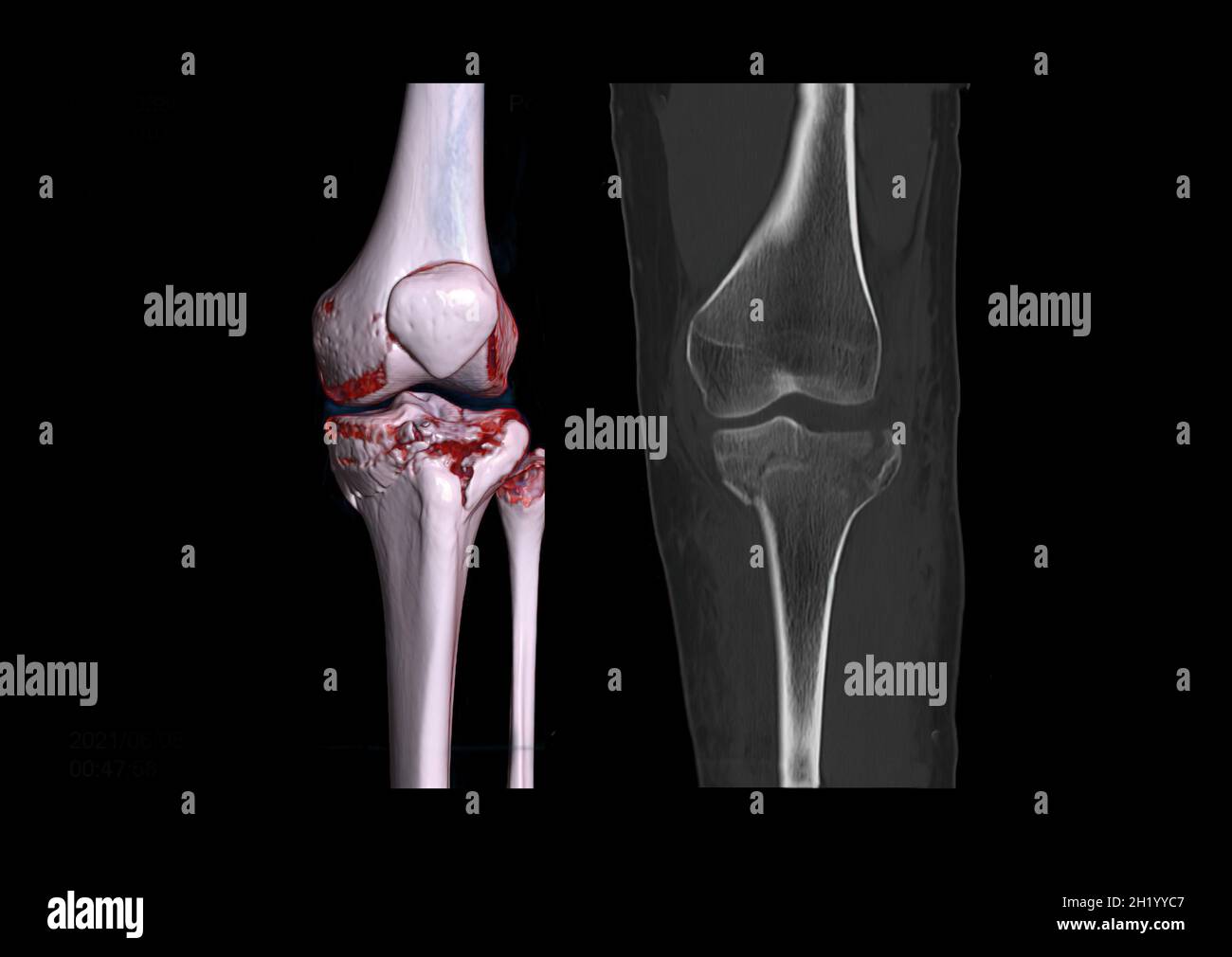 Compare of CT knee joint 3D rendering image and CT knee 2D Coronal view ...