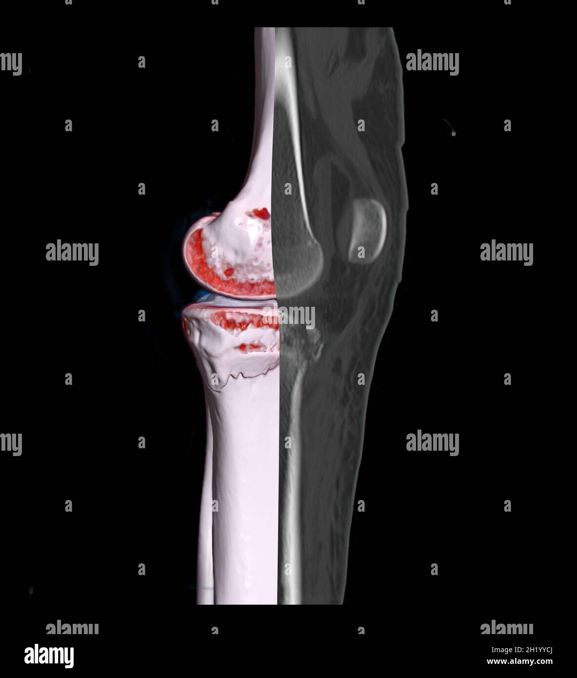 Compare of CT knee joint 3D rendering image and CT knee 2D isolated on ...