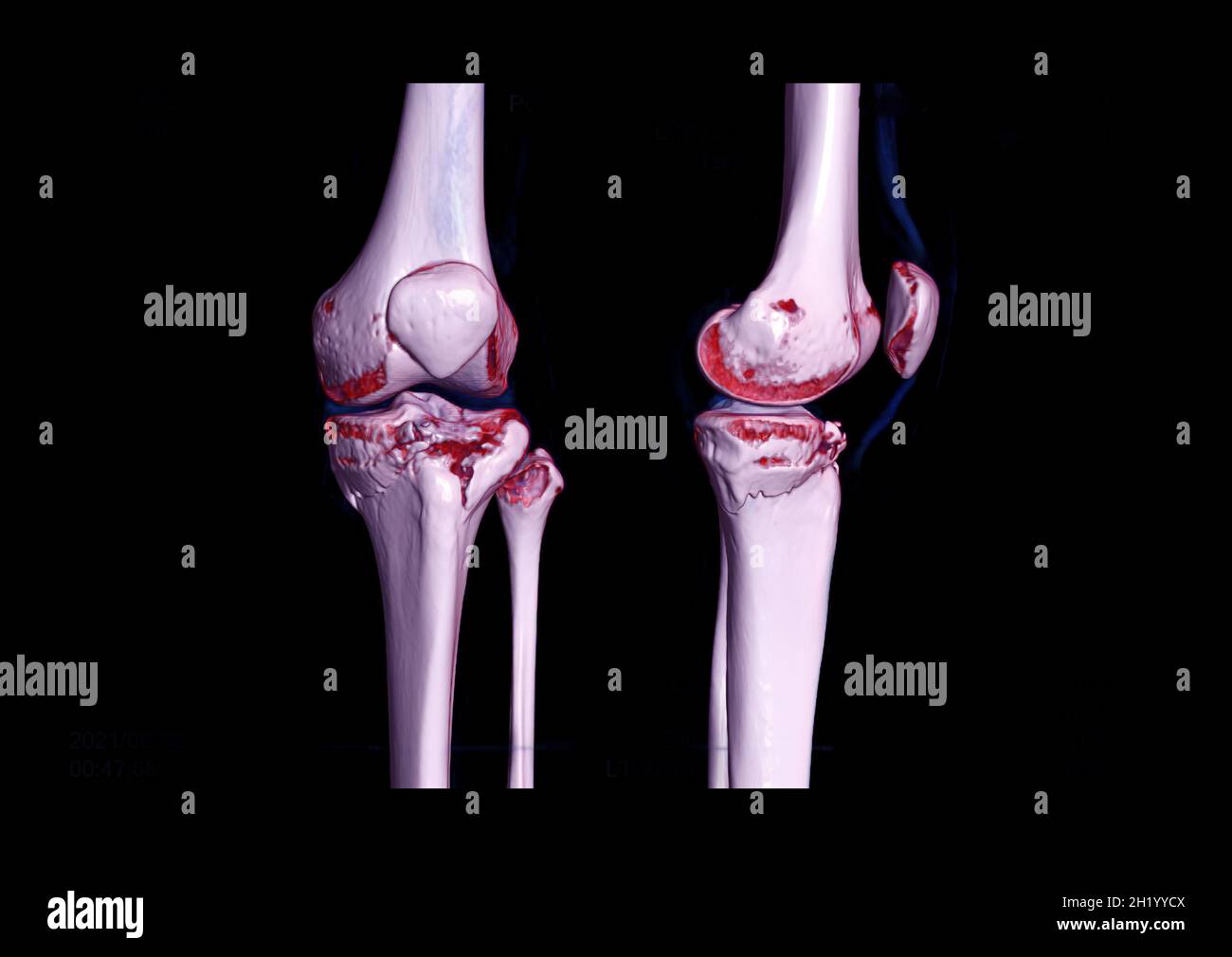 Compare AP and lateral view of CT knee joint 3D rendering image showing ...