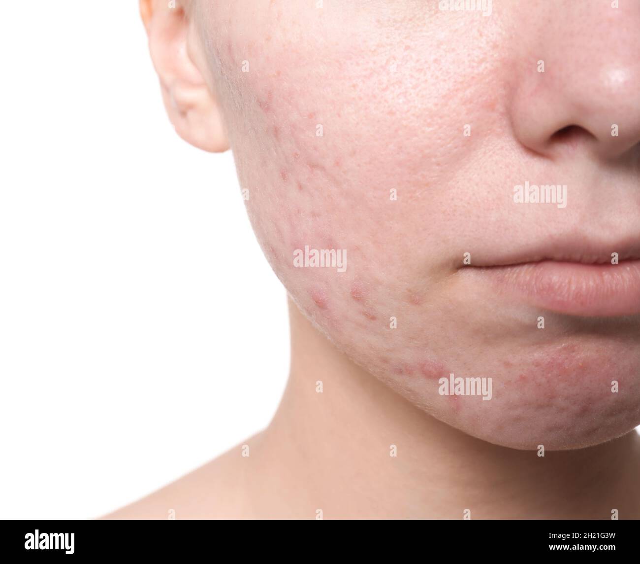 White spots on cheek hi-res stock photography and images - Alamy