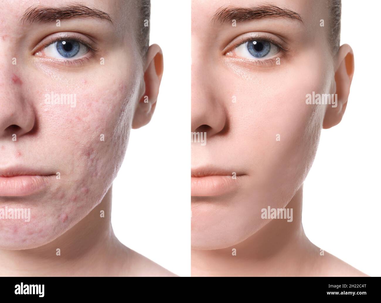 Pimples before after hi-res stock photography and images - Alamy