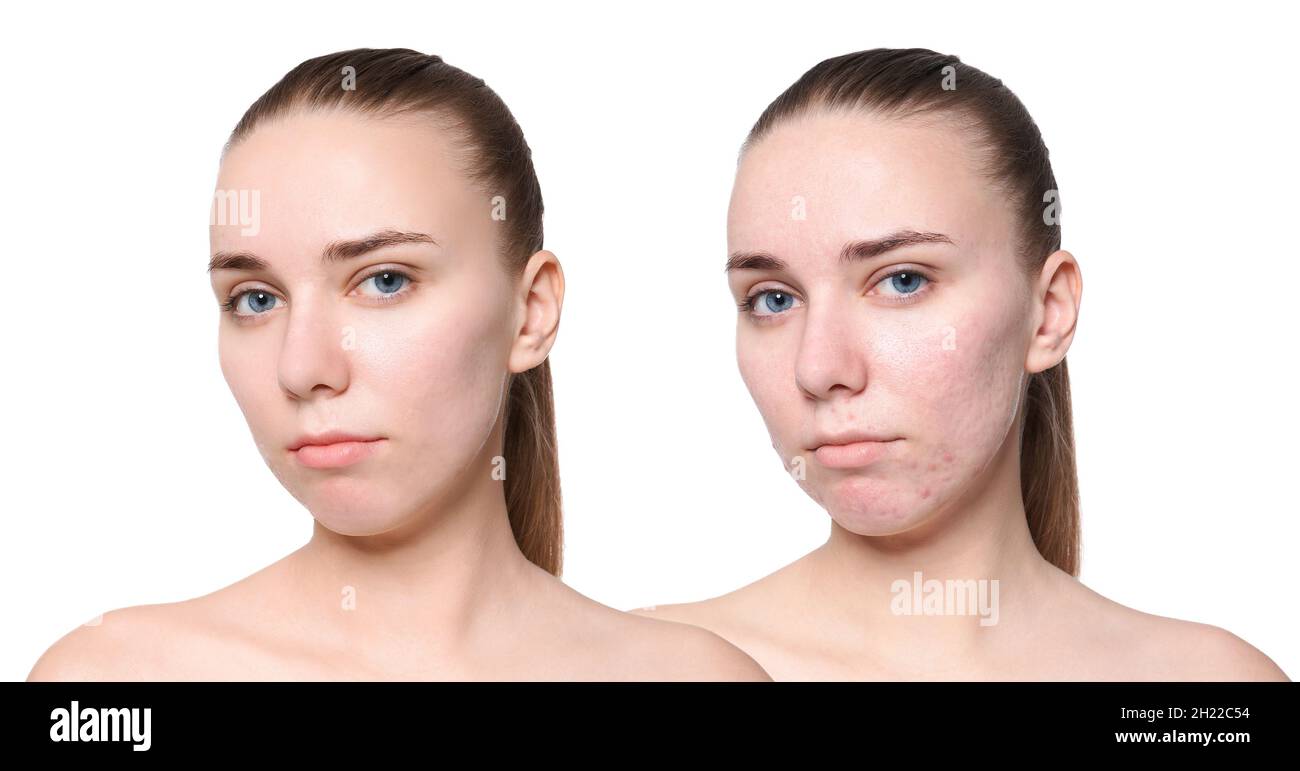 Young woman before and after acne treatment on white background. Skin care concept Stock Photo ...