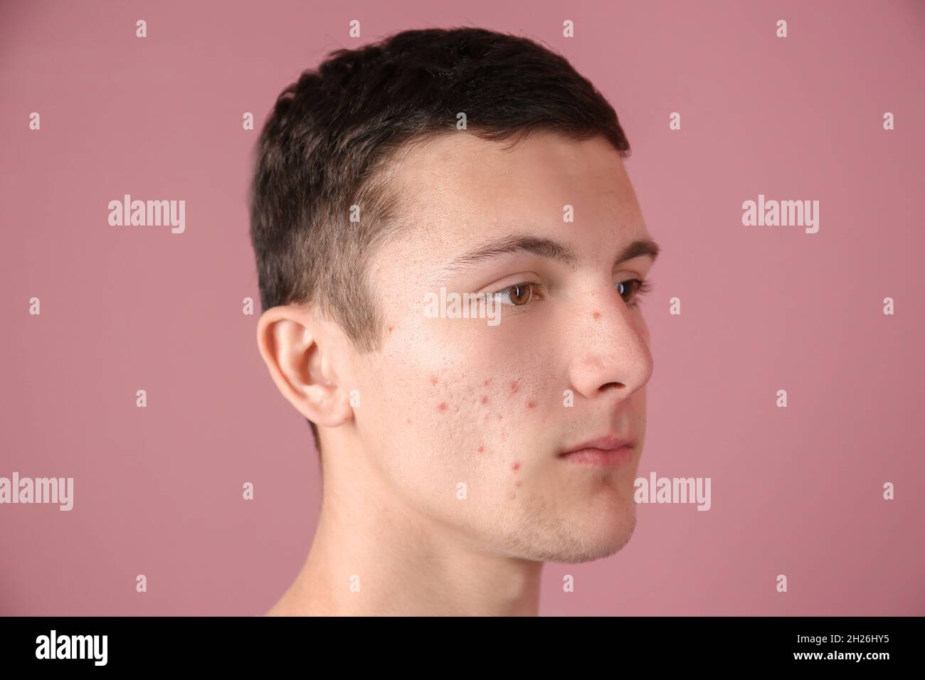 Young man with acne problem on color background Stock Photo - Alamy