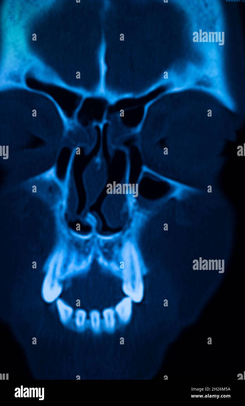 Xray scan skull nose medical exam results from hospital clinic Stock ...